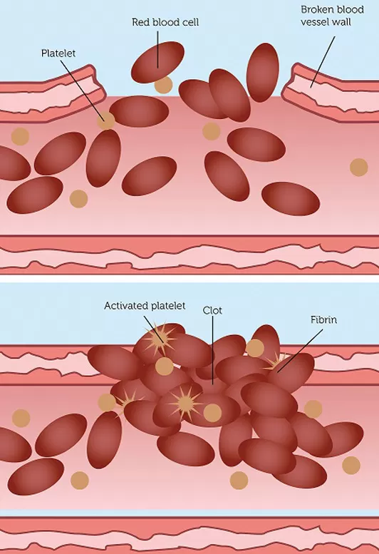 Idiopathic Thrombocytopenic Purpura Diagram